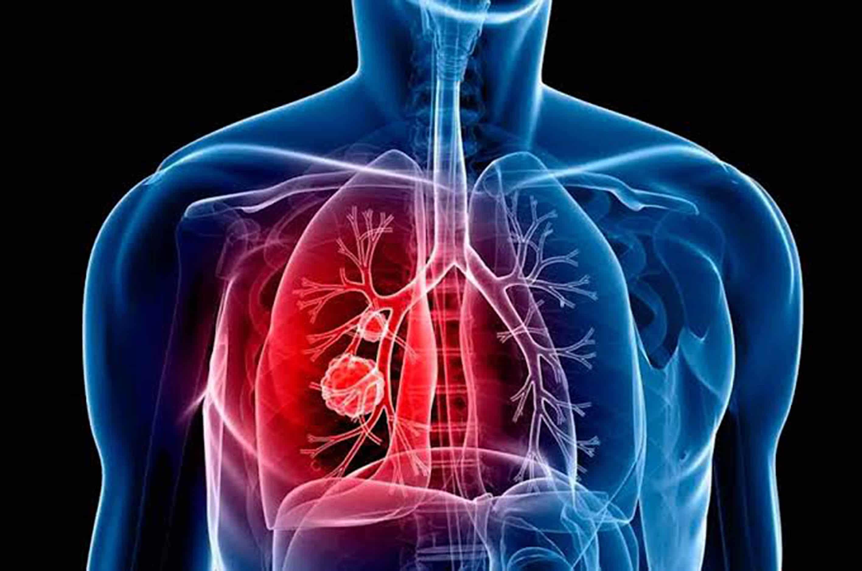 Signos a los que debes estar alerta en caso de neumonía | Quinto Poder